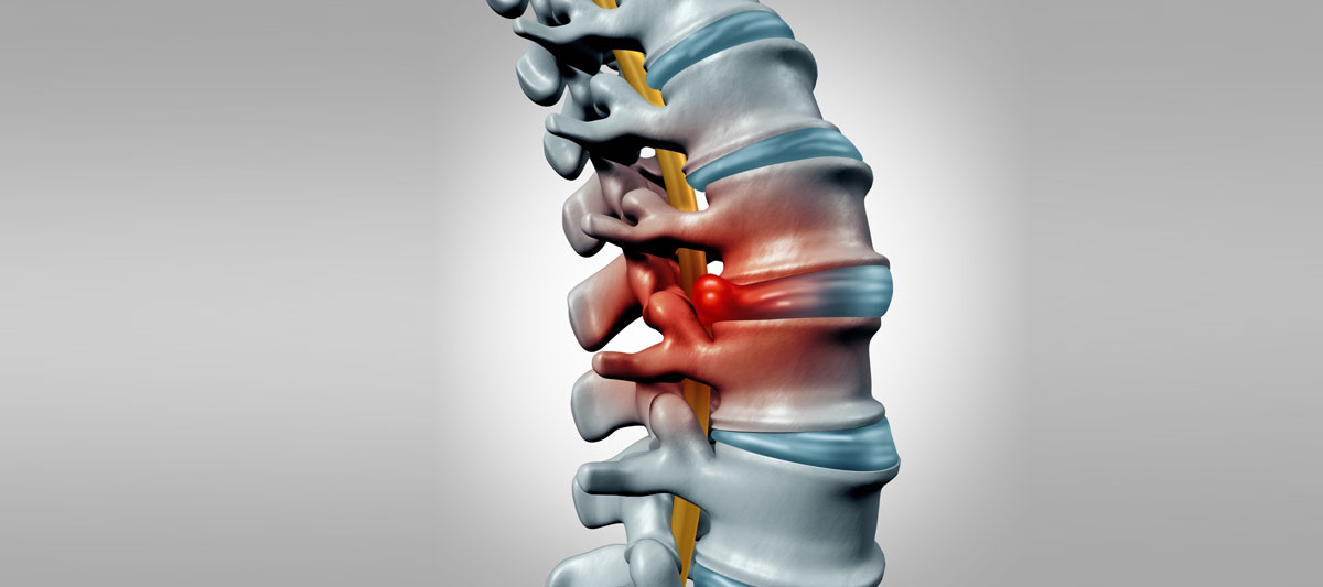 I.V.D.P (Intervertebral Disc Prolapse) - Best Ayurvedic Hospital And ...